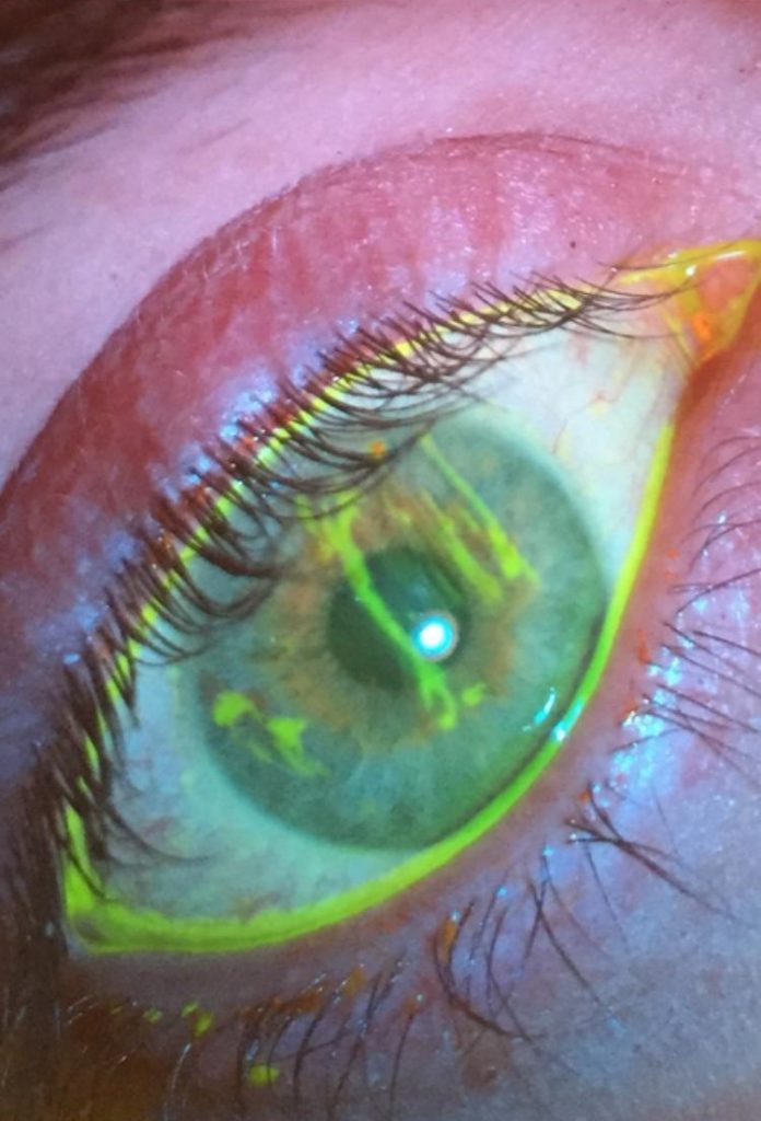 Watery eyes affects your daily routine!!! Do you know what are the ...